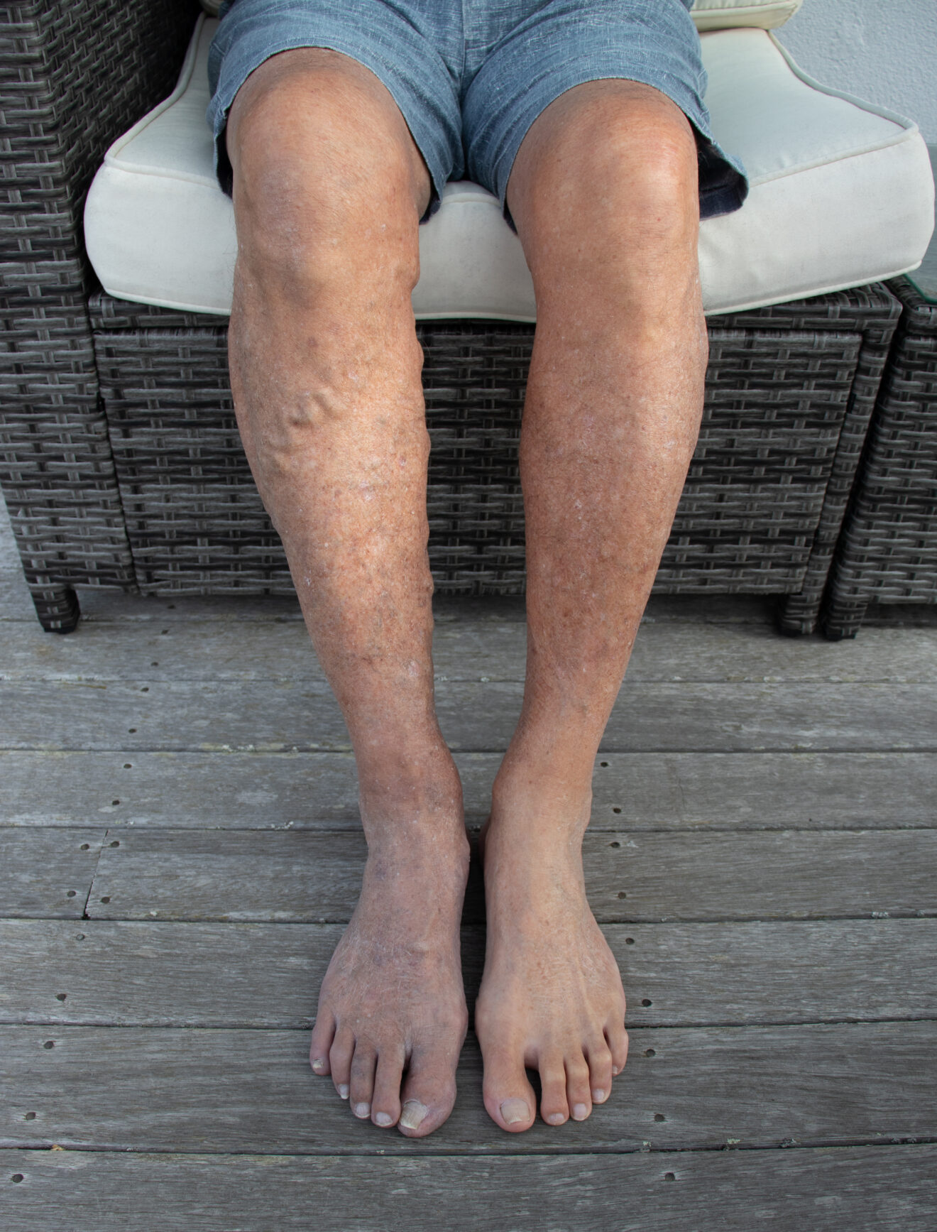 Circulation Issues in Legs: Causes, Symptoms, and Treatment - Wellness ...