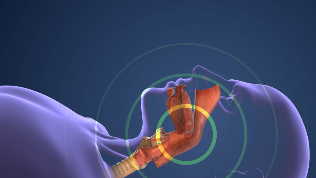 Why Patients Prefer an Oral Appliance for Sleep Apnea - Wellness and Pain